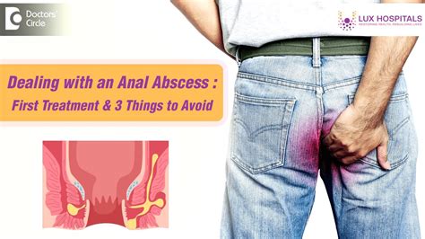 Bottom Itch 3 Things To Avoid In Anal Abscess Perianal Abscess