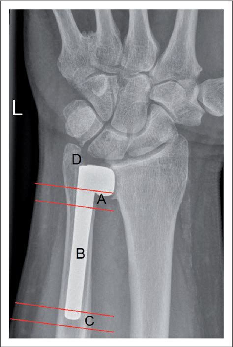 Figure 1 From Clinical Radiological And Patient Rated Outcome
