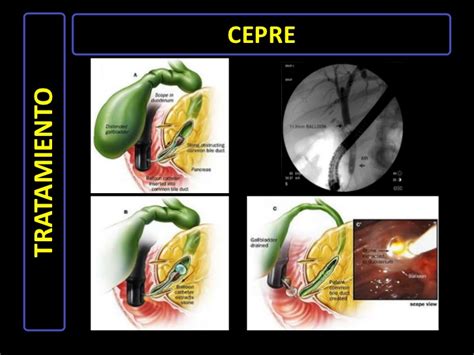 Medicina Indicaciones De Cpre