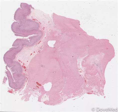 Leiomyoma Of The Genitourinary System Dovemed
