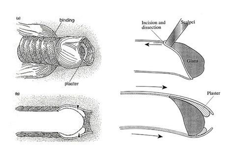 Urología E Historia De La Medicina La Circuncisión En La Historia