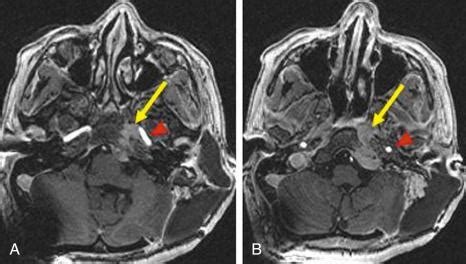 Endoscopic Management Of Clival Chordomas And Chondrosarcomas Clinical Tree