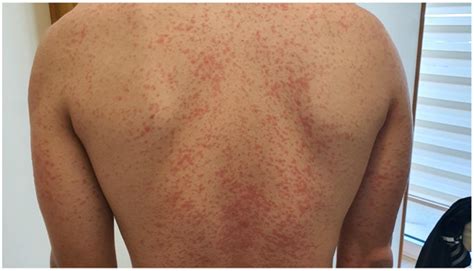 Cutaneous Side Effects Of Modern Targeted Therapy And Immunotherapy In