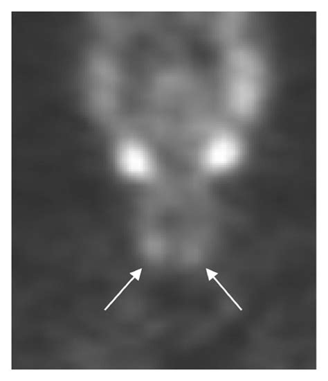 Parathyroid Adenomas On Magnetic Resonance Imaging Mri A 67 Year Old