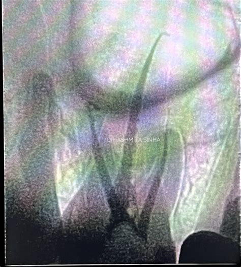 Dr Ashmita Sinha On Linkedin Rountine Endodontics