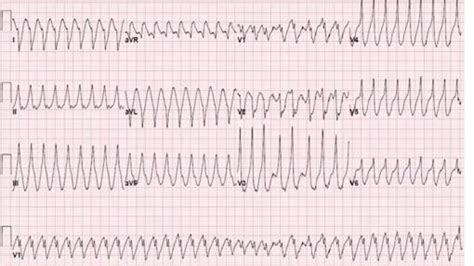 Arrythmias Narrow Complex Tachycardias Pptx