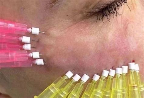 Pdo Thread Lifting For Tear Trough Rejuvenation Diaminyaesthetics