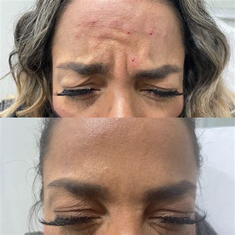 Botox Before And After 3d Lifestyle Canada