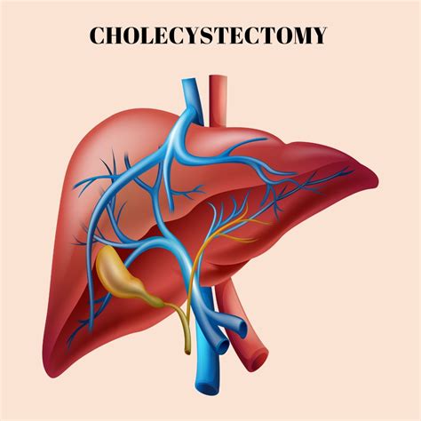 Cholecystectomy Cholelithiasis