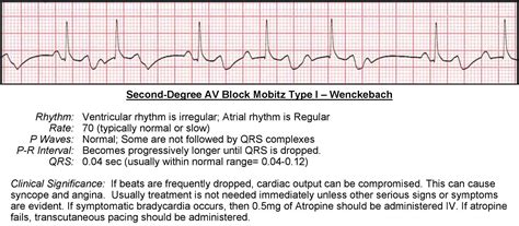 Third Degree Av Block
