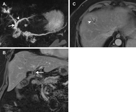 Imaging After Pancreatic Surgery Expected Findings And Postoperative