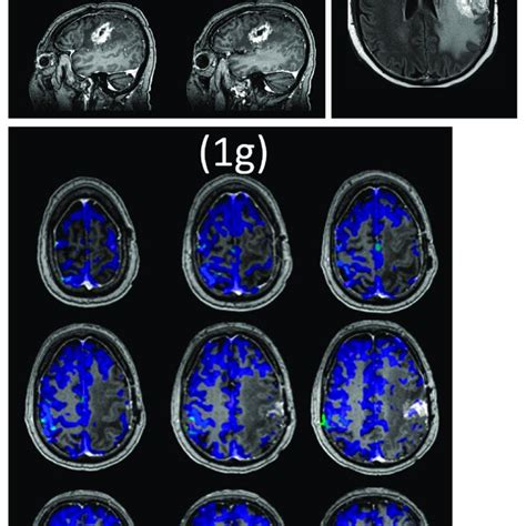 Sensorimotor Mapping Using Task Fmri With Demonstration Of