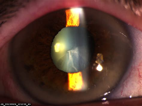 Cortical Cataract The Cataract Course