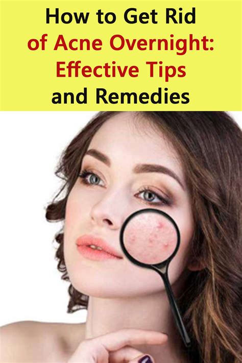 How To Get Rid Of Acne Overnight Effective Tips And Remedies Health