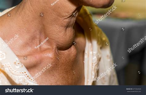 Lump On Neck