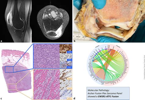 A Radiologic Image Of A Soft Tissue Mass Knee With Involvement Of
