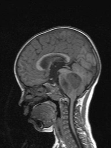 Diffuse Brainstem Glioma Pacs
