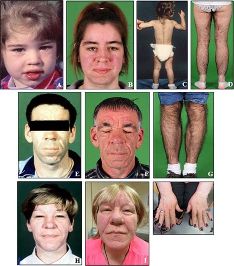 Congenital Hypertrichosis Universalis