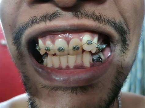 15 Years Progress Rbraces