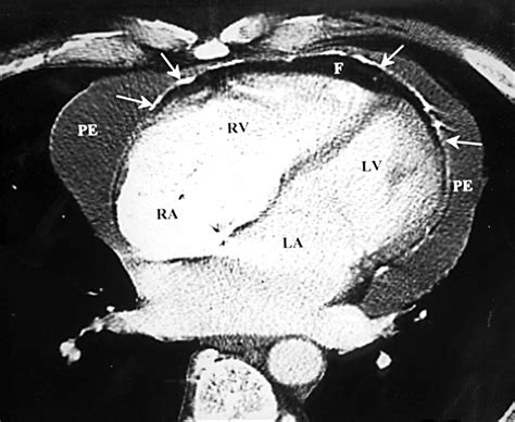Effusiveconstrictive Pericarditis Heart