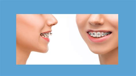 What Is An Overbite And How Can It Be Fixed