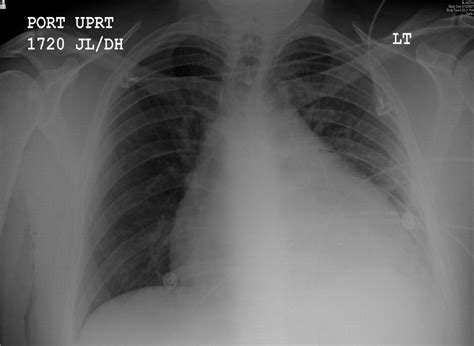 Transient Constrictive Pericarditis With Videographic Display Of