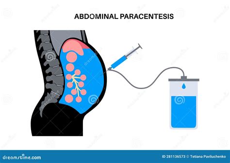 Abdominal Paracentesis Poster Stock Vector Illustration Of Peritoneum