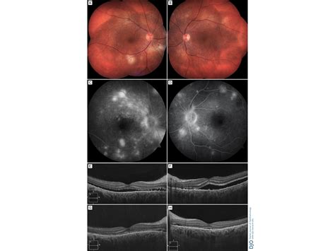 Digital Journal Of Ophthalmology