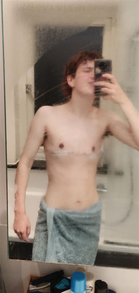 Ive Been On Testopel Testosterone Pellets For Nearly 2 Years My