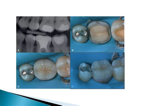 Restoration Of Endodontically Treated Teeth Pptx