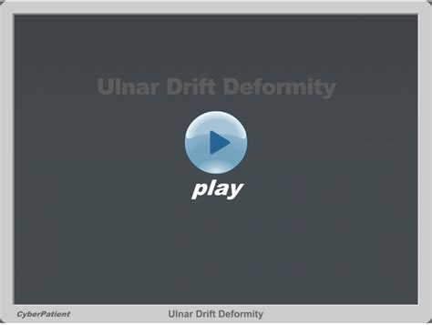 Ulnar Drift Deformity In Rheumatoid Arthritis Educational Resources