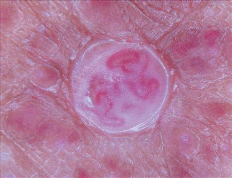 Dermoscopy Of Arteriovenous Hemangioma Indian Journal Of Dermatology