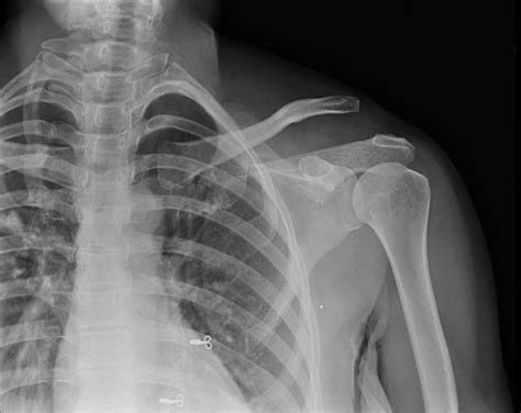 Acromioclavicular Joint X Ray Ac Joint Separation Premier Radiology