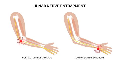 Premium Vector Ulnar Nerve Entrapment