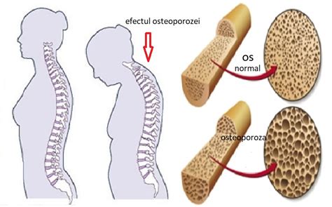 Osteoporoza Argila Albastra