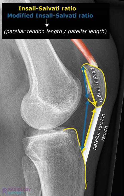 What Is The Patellofemoral Compartment Of The Knee