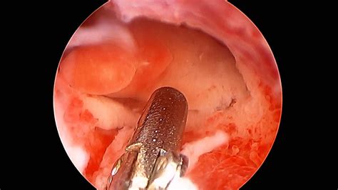Hysteroscopic Polypectomy Of A Sessile Endometrial Polyp Youtube