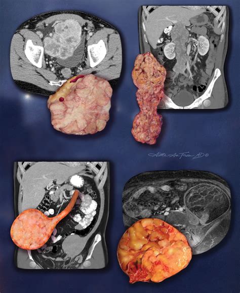 Primary Retroperitoneal Sarcomas Radiographics
