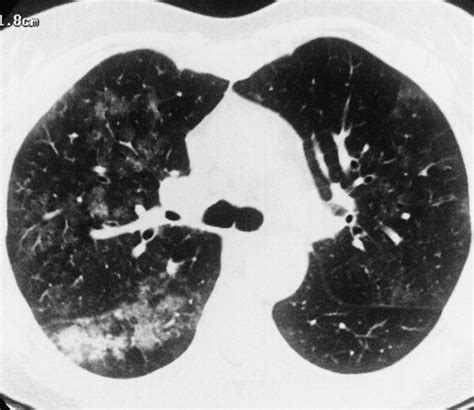 Thoracic Manifestations Of Systemic Autoimmune Diseases Radiographic