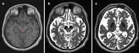 Mri Findings Of The Patient Indicate Cerebral And Cerebellar Atrophy