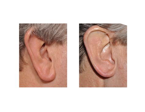 New Technique In Earlobe Reduction Surgery Explore Plastic Surgery