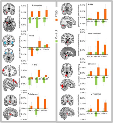 Regions Of Fear Generalization Bias In Ptsd Fear Generalization