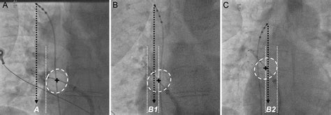 Safety And Efficacy Of A Second Generation Cryoballoon In The Ablation Of Paroxysmal Atrial