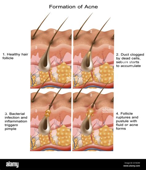 Hair Follicle Infection