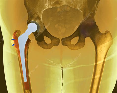 Total Hip Replacement X Ray Stock Image M6000364 Science Photo