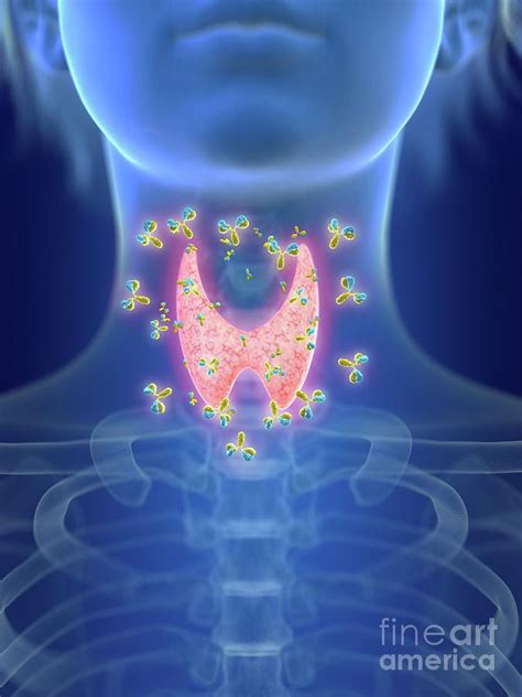 Illustration Of Autoimmune Thyroid Disease Photograph By Sebastian
