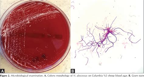 Figure 1 From Pulmonary Nocardiosis Caused By Nocardia Abscessus Mimicking Pulmonary