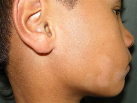 Pityriasis Alba On Face Pityriasis Alba Photos Etdkhl
