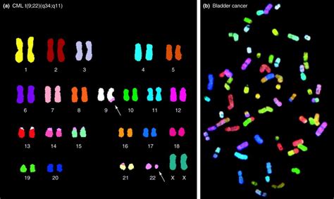 Sickle Cell Anemia Karyotype Sickle Cell Anemia Karyotype