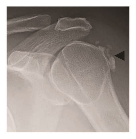 Calcific Tendinopathy Of The Rotator Cuff A Calcific Tendinopathy Of